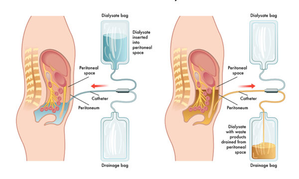 Peritoneal Dialysis In Bangalore Dr Pallavi Patri